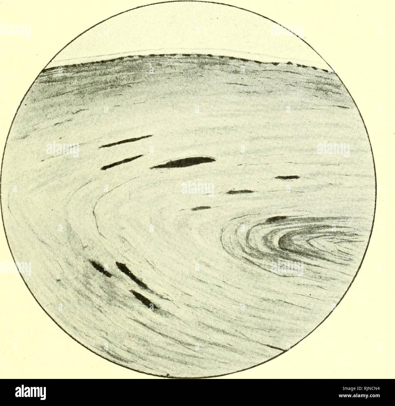 Cataract eye congenital hi-res stock photography and images - Alamy