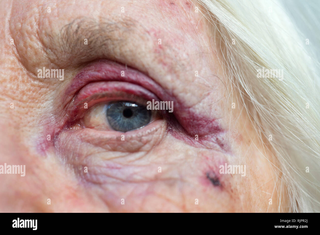 Self portrait with black eye, February 1st 2019 Stock Photo - Alamy