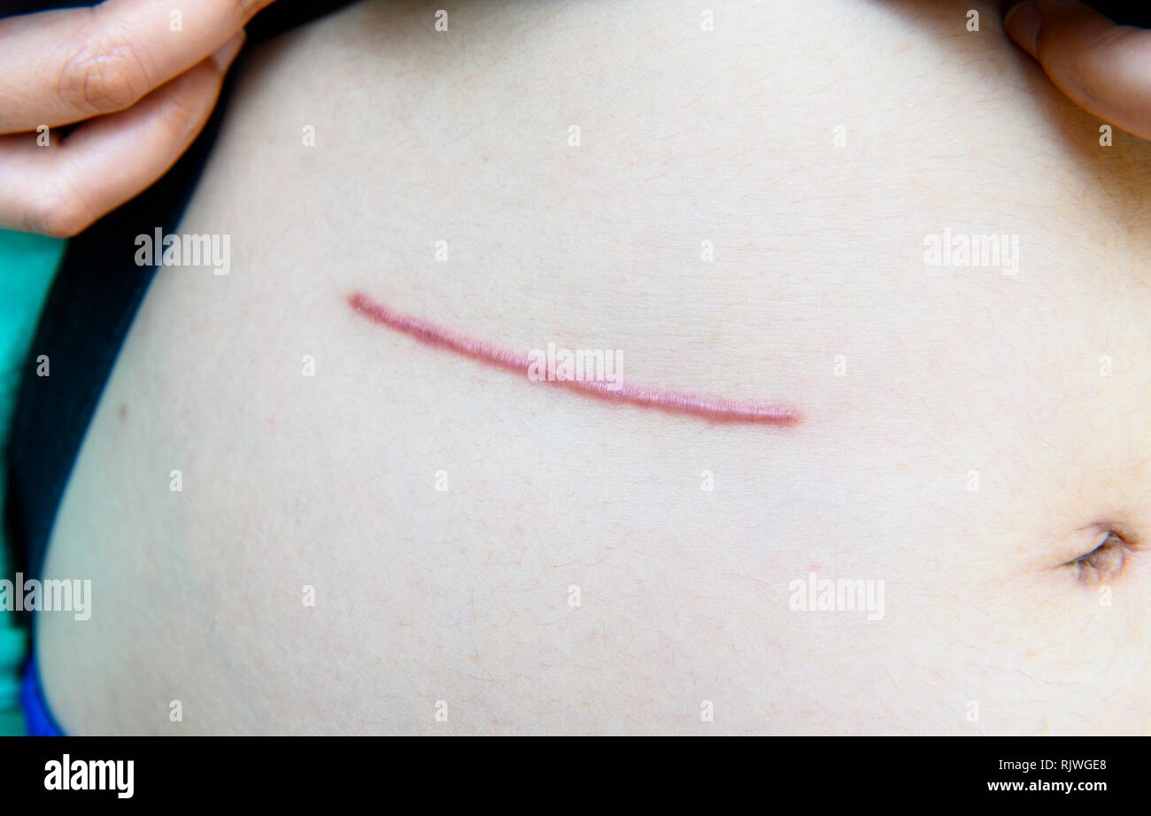 Stomach scar operation hi-res stock photography and images - Alamy