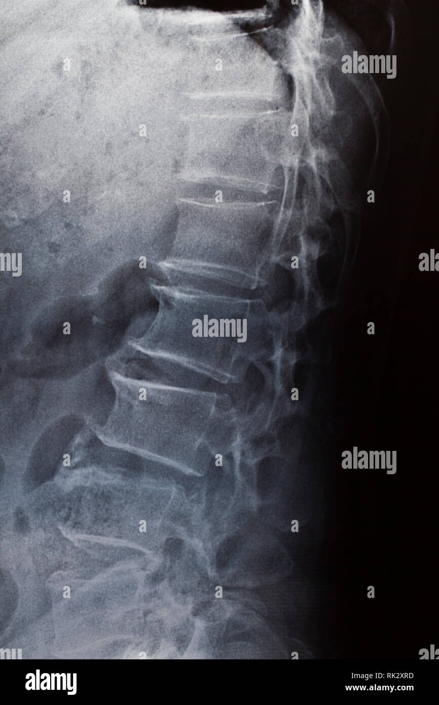 Human spine shadow hi-res stock photography and images - Alamy