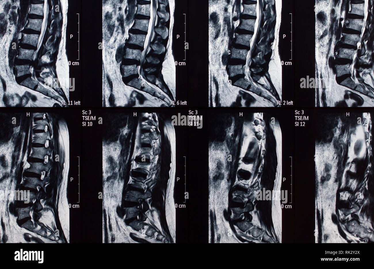 Perspective photo of human spine Stock Photo - Alamy