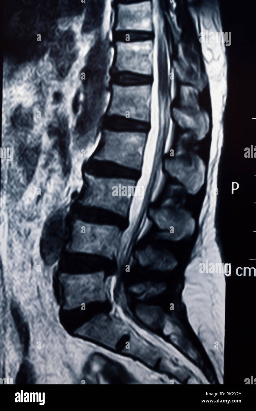 Perspective photo of human spine Stock Photo - Alamy