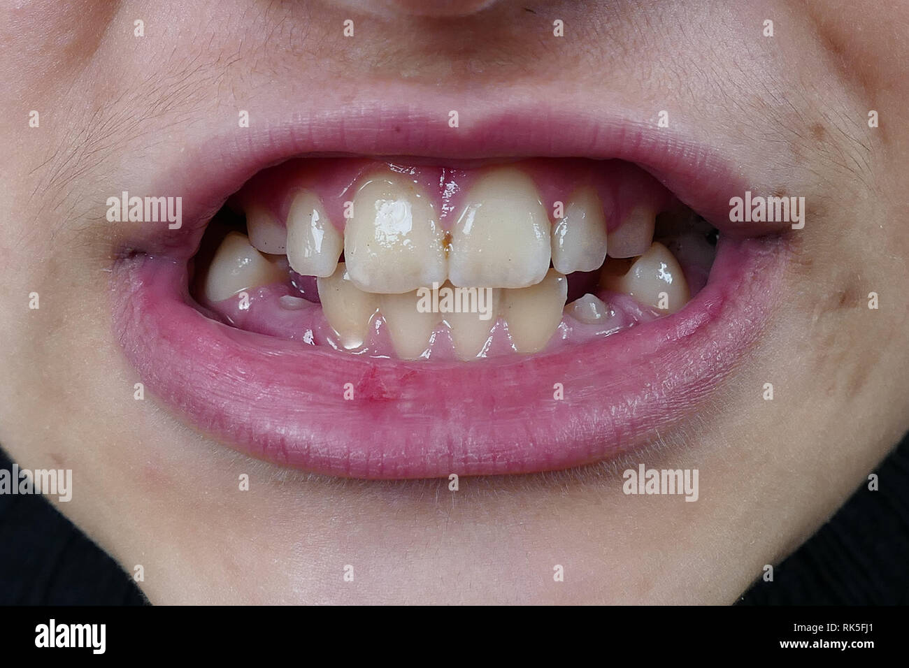 child's mouth and teeth, the arrival of new teeth instead of the teeth ...