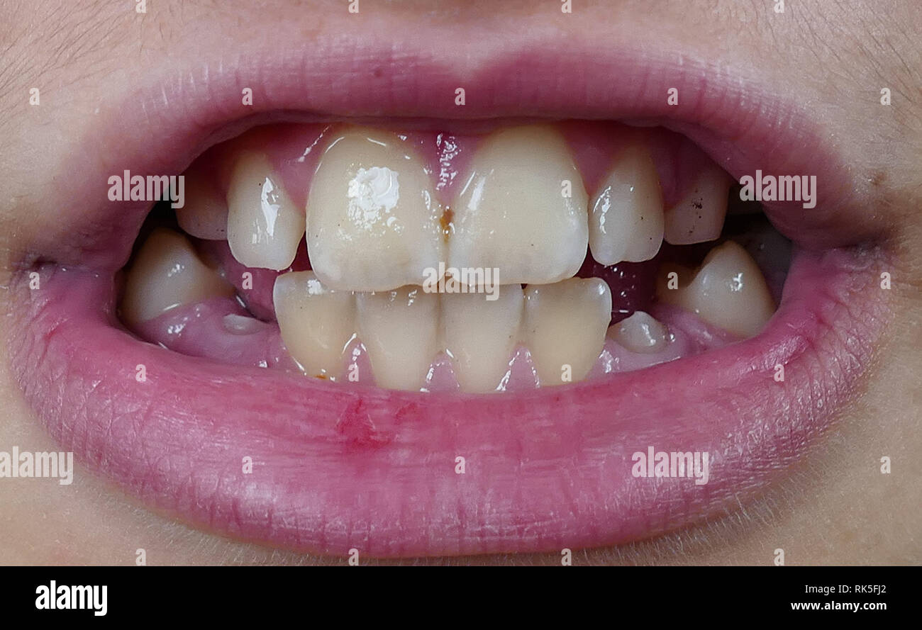 child's mouth and teeth, the arrival of new teeth instead of the teeth ...