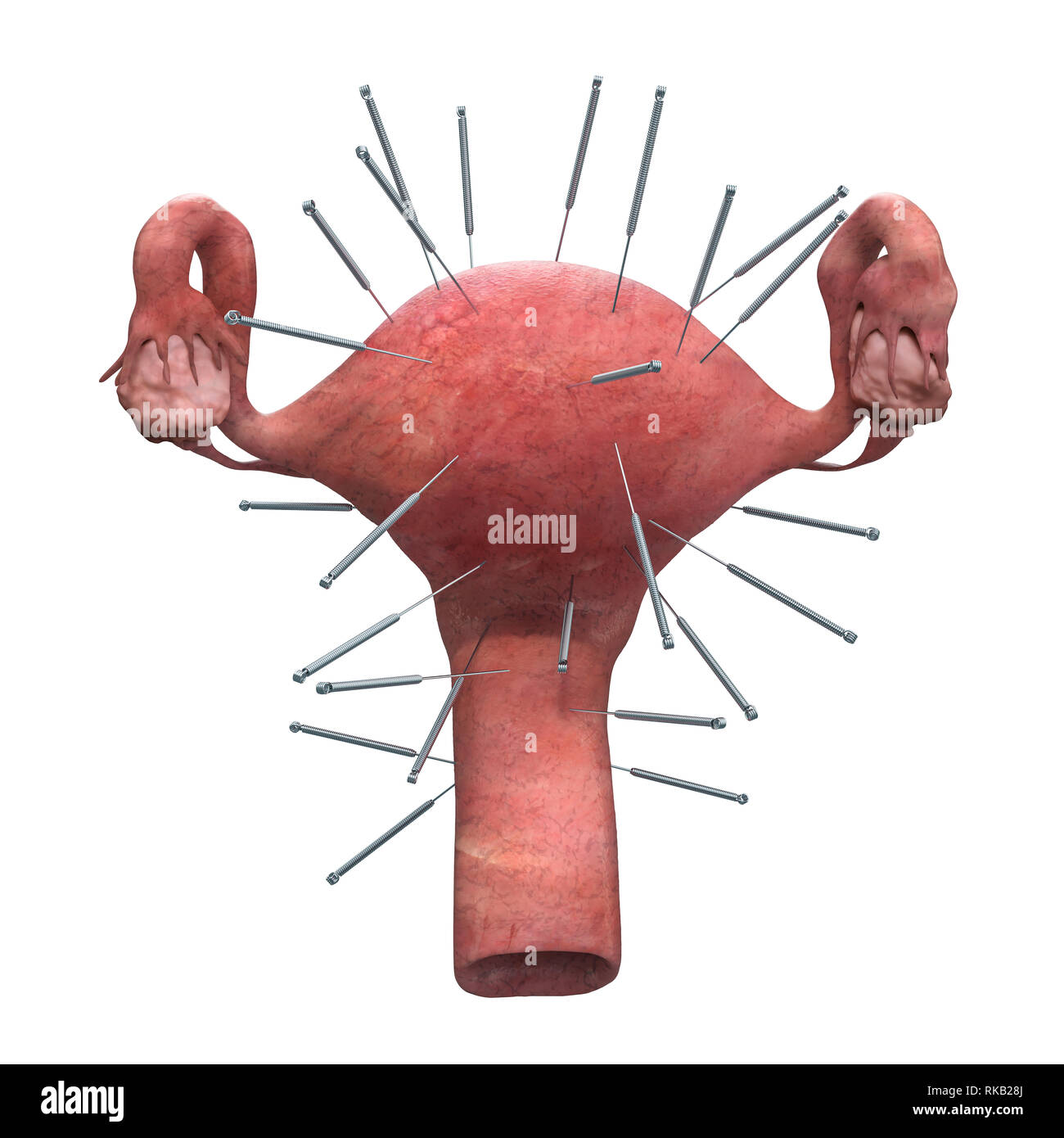 Female uterus with acupuncture needles. Acupuncture treatment of uterus ...