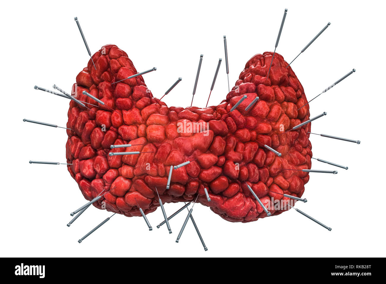 Human thyroid with acupuncture needles. Acupuncture treatment of ...