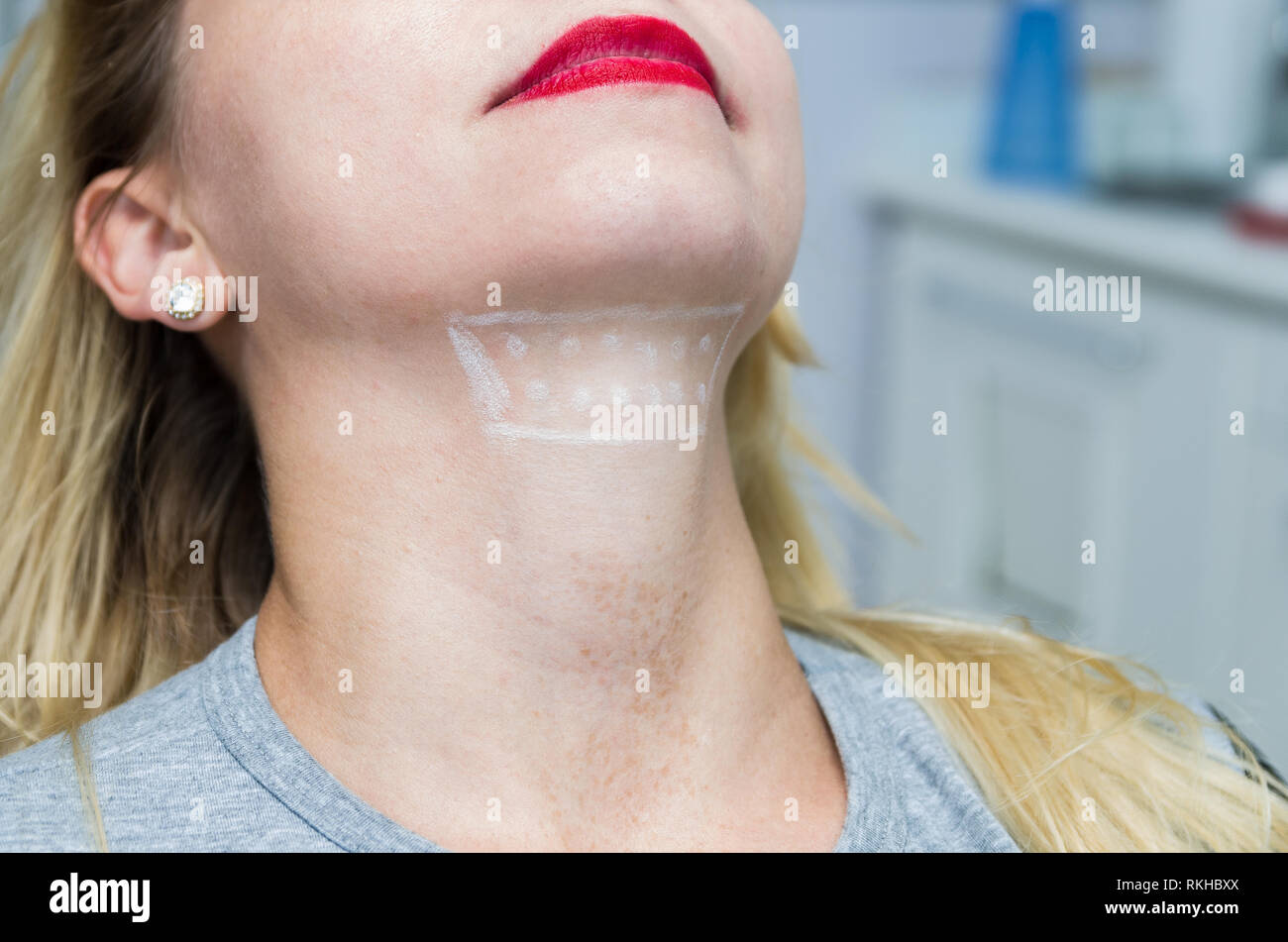 Great concept of aesthetic treatment of jowls, injection of deoxycholic ...