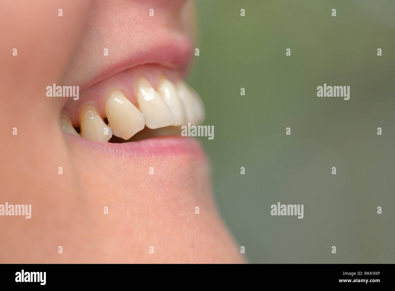 Parodontose hi-res stock photography and images - Alamy