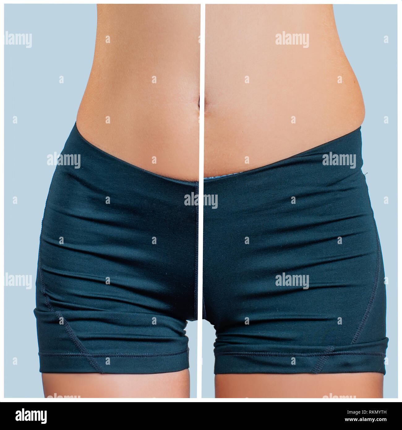 Female body before and after liposuction. Plastic surgery concept and ...
