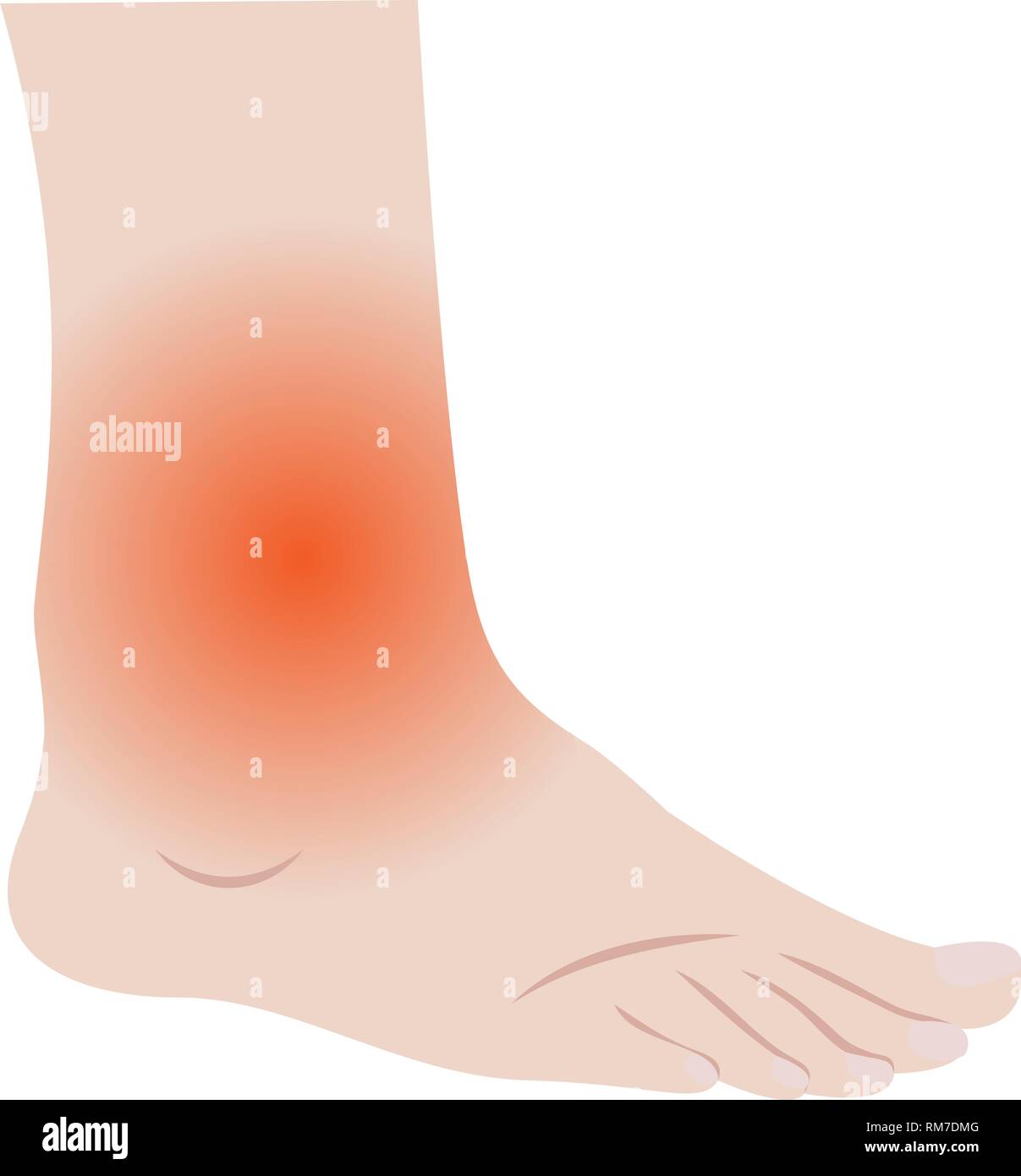Swelling of the feet and ankles from infected or injury vector ...