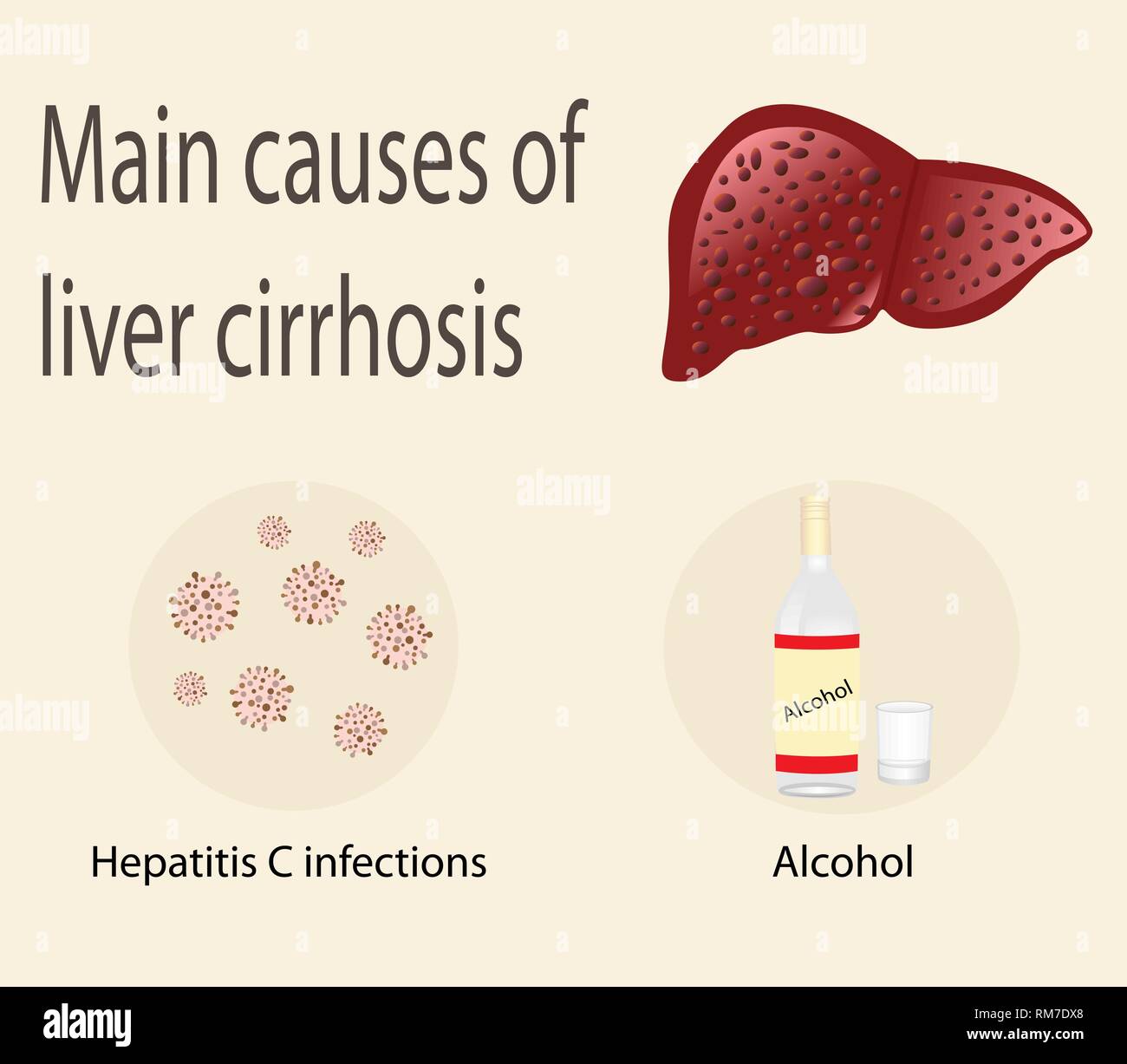 Main causes of liver cirrhosis hepatitis C infection and alcohol vector illustration ...