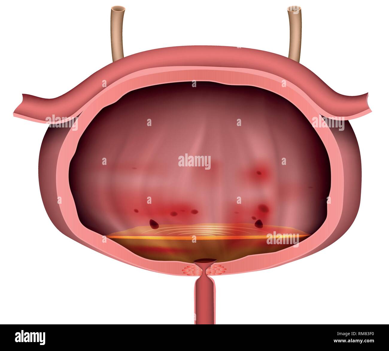 Bladder inflammation 3d vector illustration unlabeled on white ...