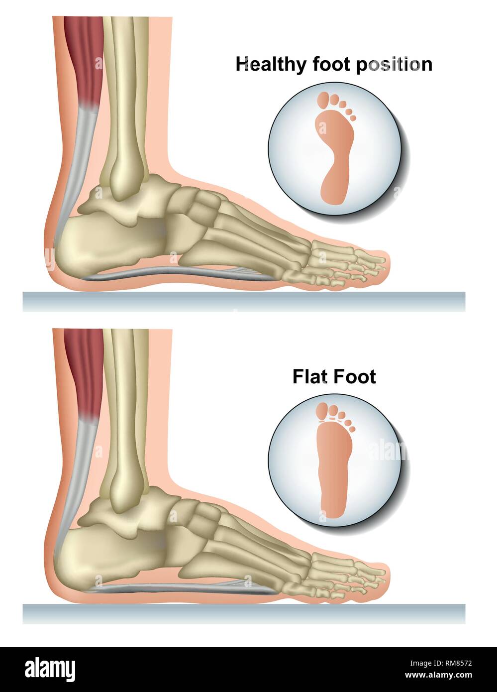 Flat foot medical vector illustration on white background Stock Vector ...