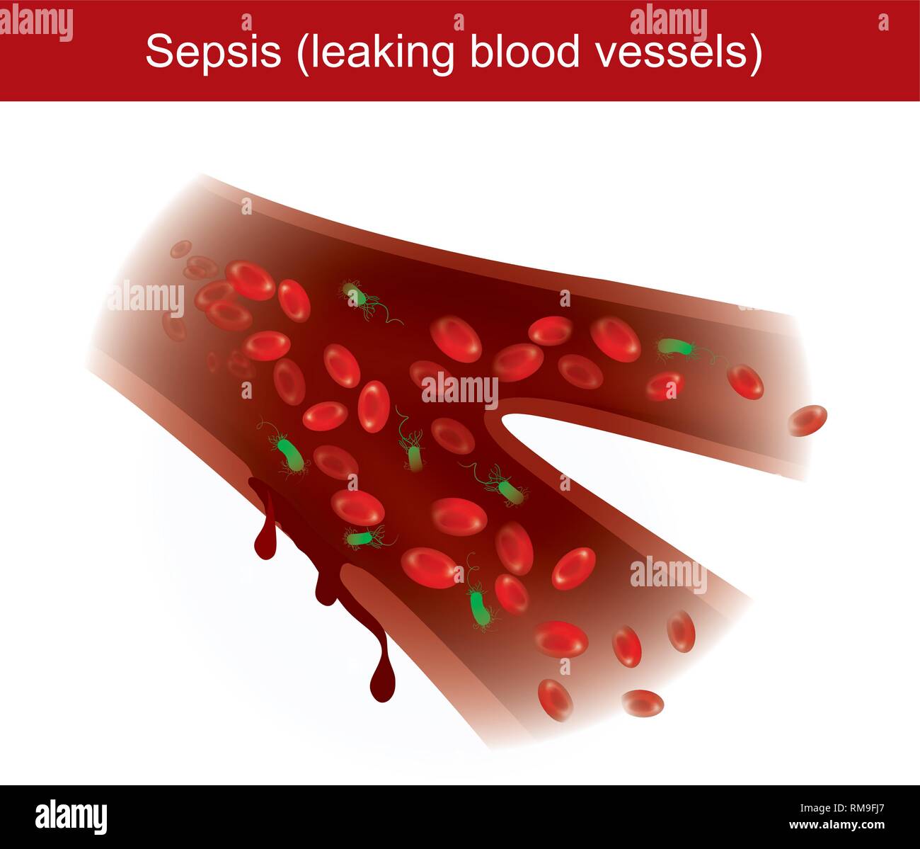 Inflammation blood vessels hi-res stock photography and images - Alamy