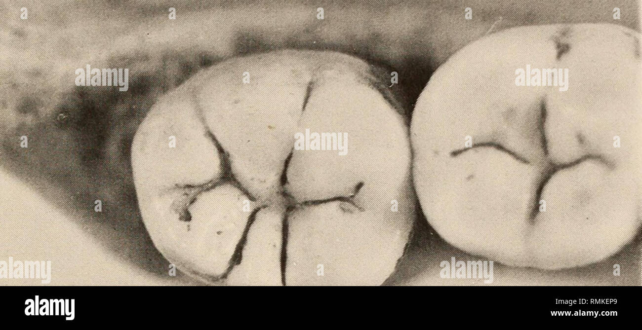 Mandibular molars hi-res stock photography and images - Alamy