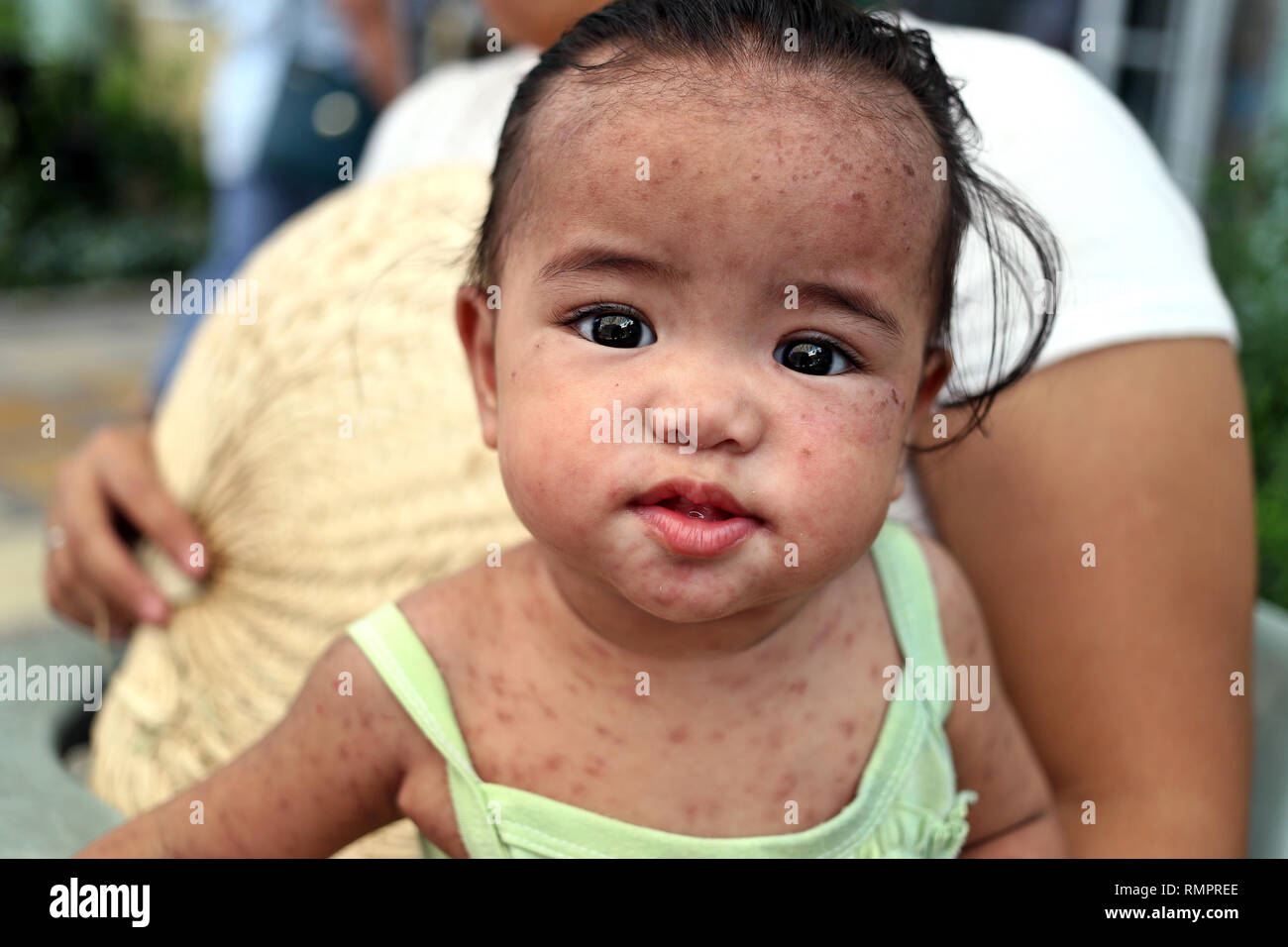 Manila, Philippines. 15th Feb, 2019. A Filipino child suffering from ...
