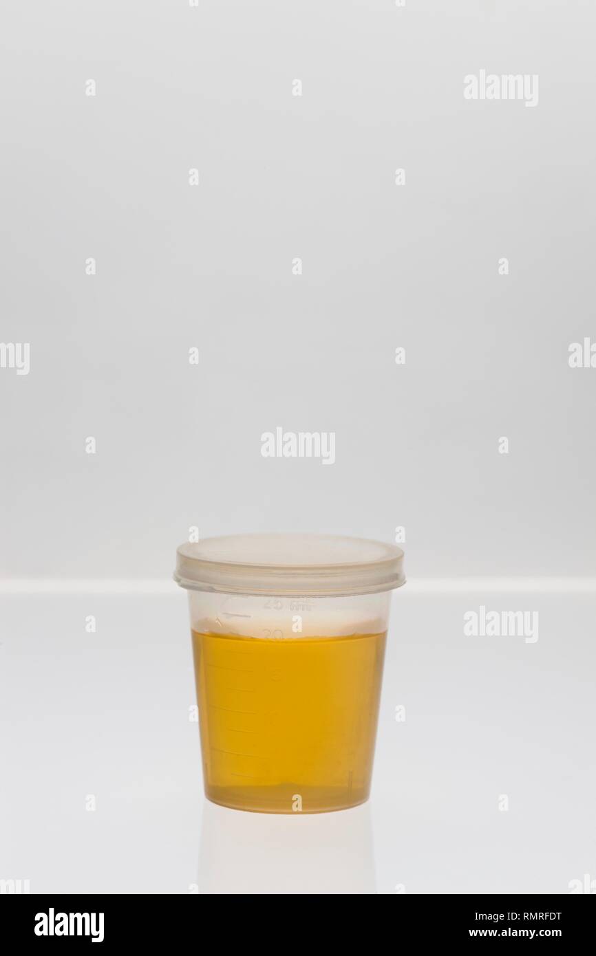 Urine sample in plastic cup Stock Photo - Alamy