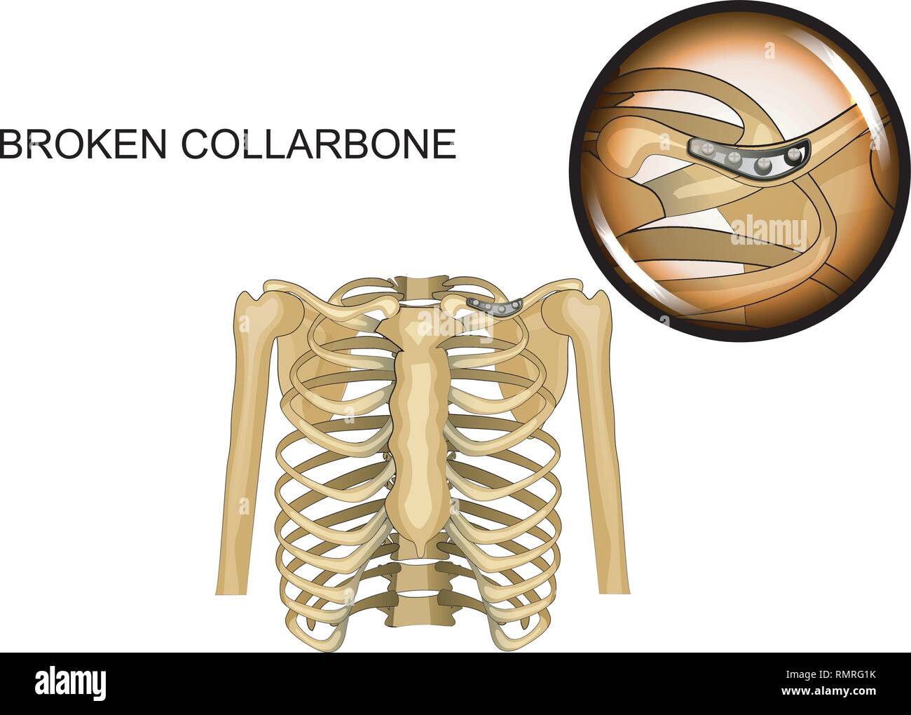 vector illustration of a broken collarbone. osteosynthesis Stock Vector ...