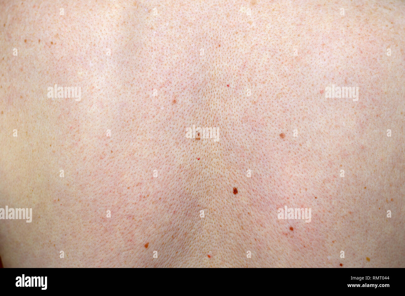 Bare skin on chest of Caucasian person with moles and freckles Stock ...