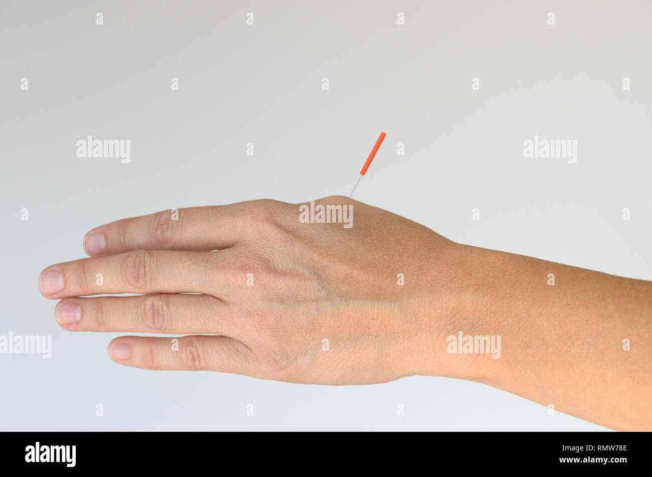 Close up of extended hand with acupuncture needle attached to the ...