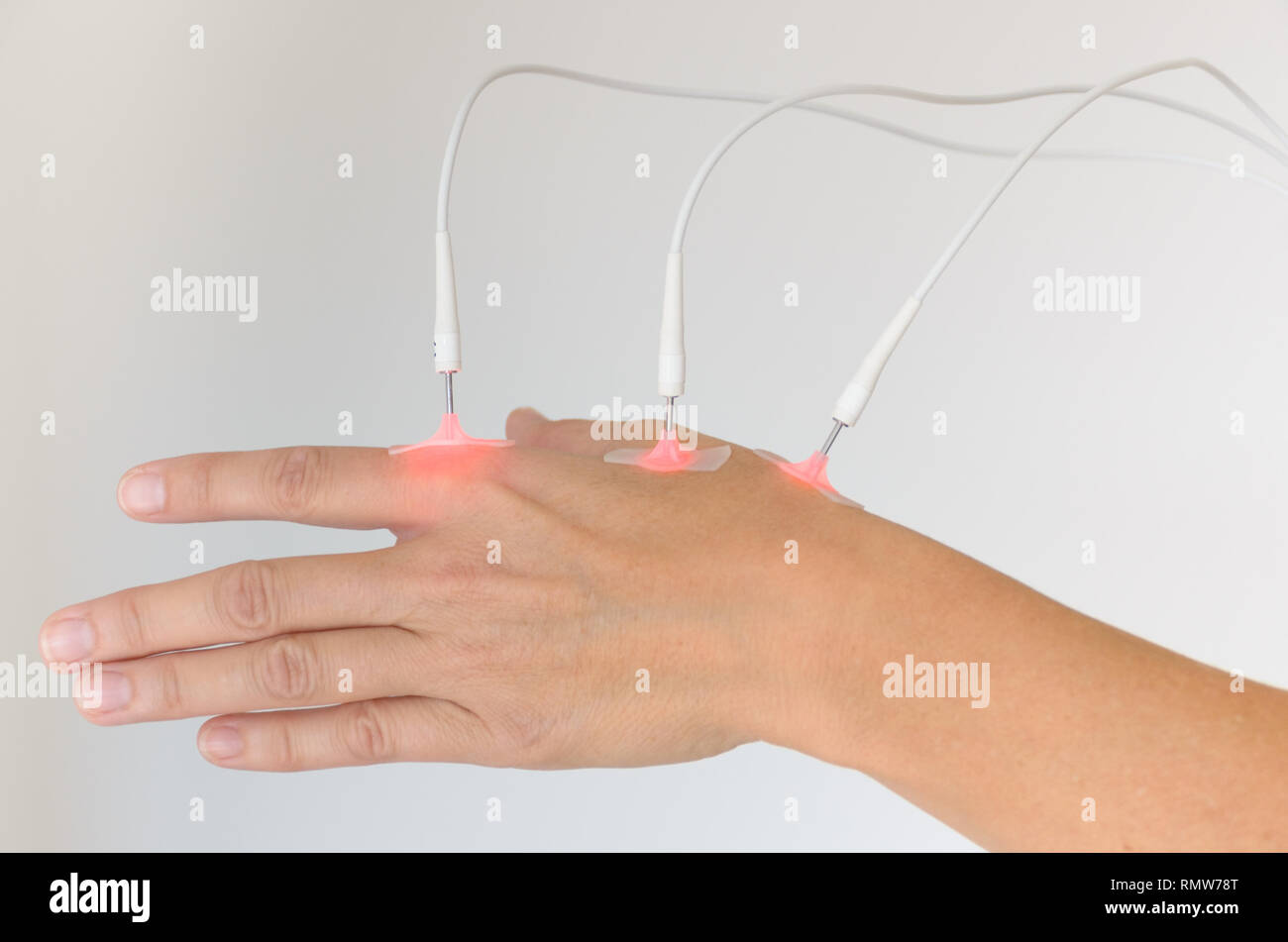Electrical stimulator hi-res stock photography and images - Alamy