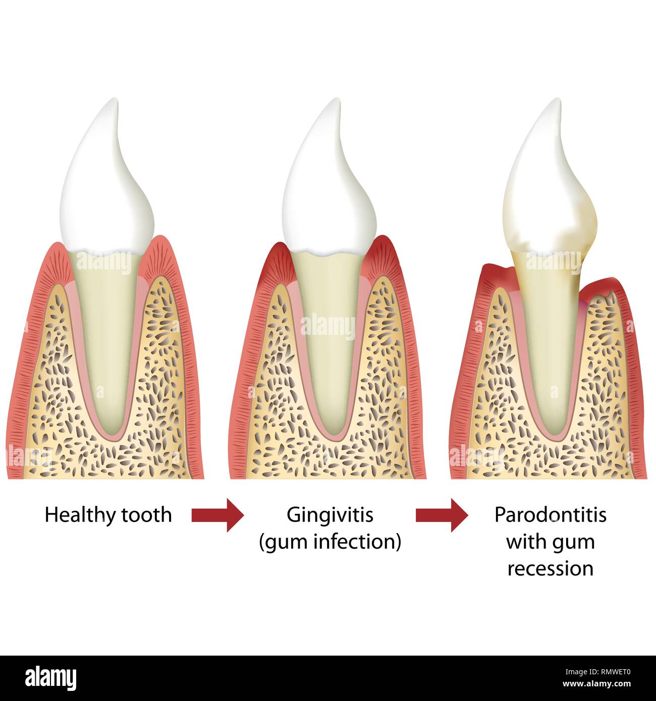 Stages of periodontitis medical vector illustration white background ...