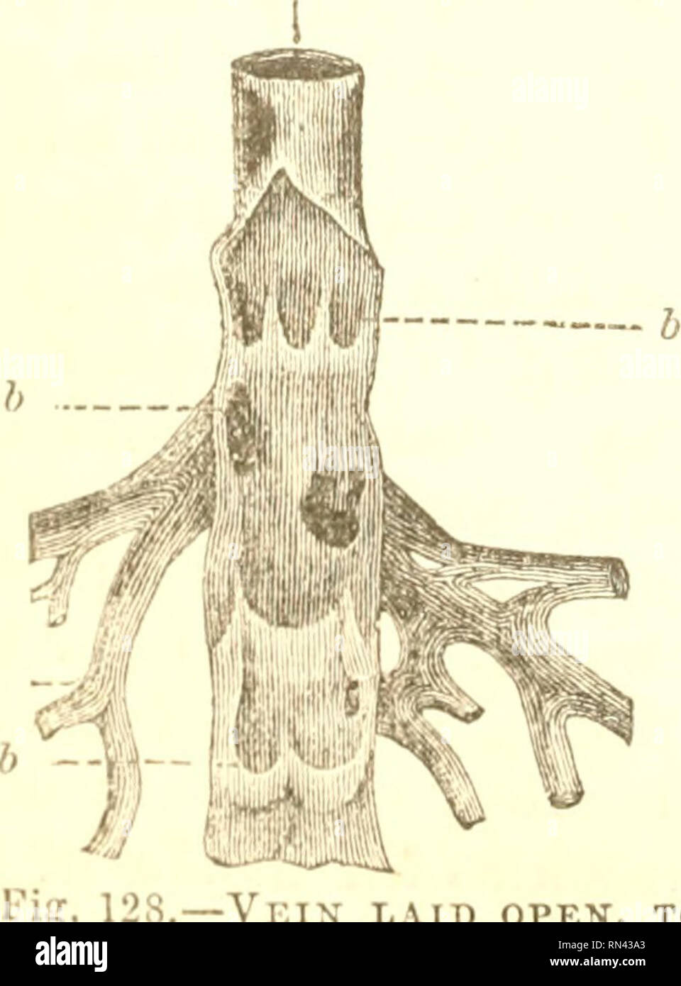 Elasticity of arteries hi-res stock photography and images - Alamy