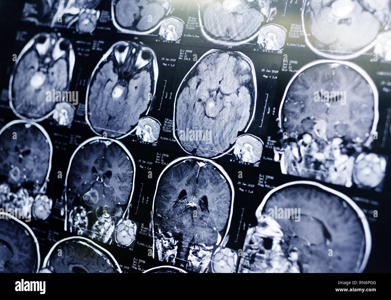 MRI scan of a patient with a tumor in the brain stem Stock Photo - Alamy