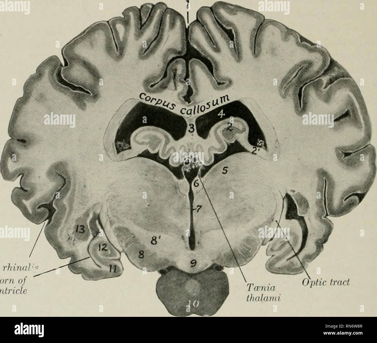 Posterior Commissure Coronal