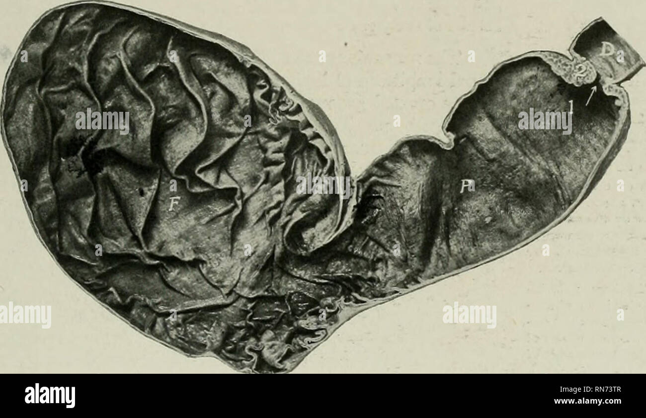 Greater omentum hi-res stock photography and images - Alamy