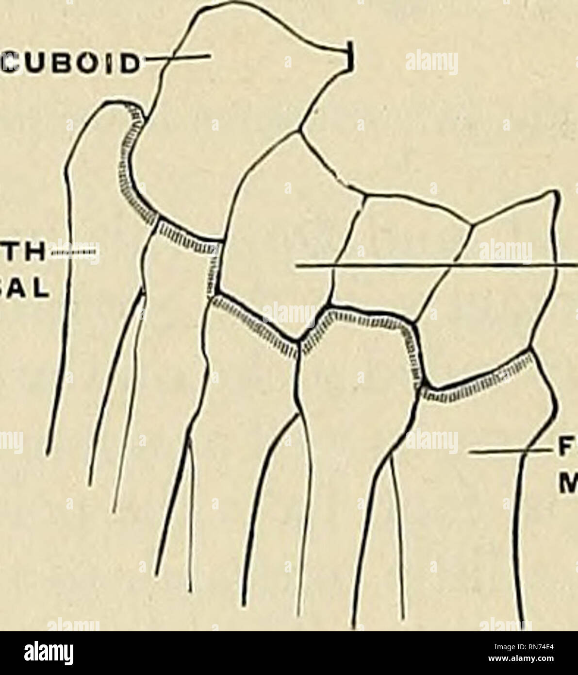 . Anatomy, descriptive and applied. Anatomy. of Chopart's amputation ...