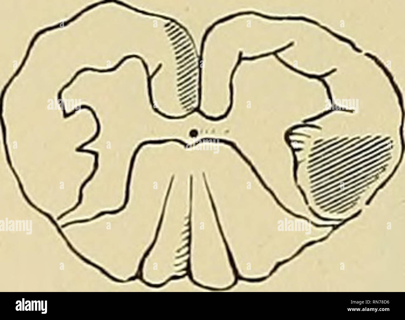 Cerebral cortex operation hi-res stock photography and images - Alamy