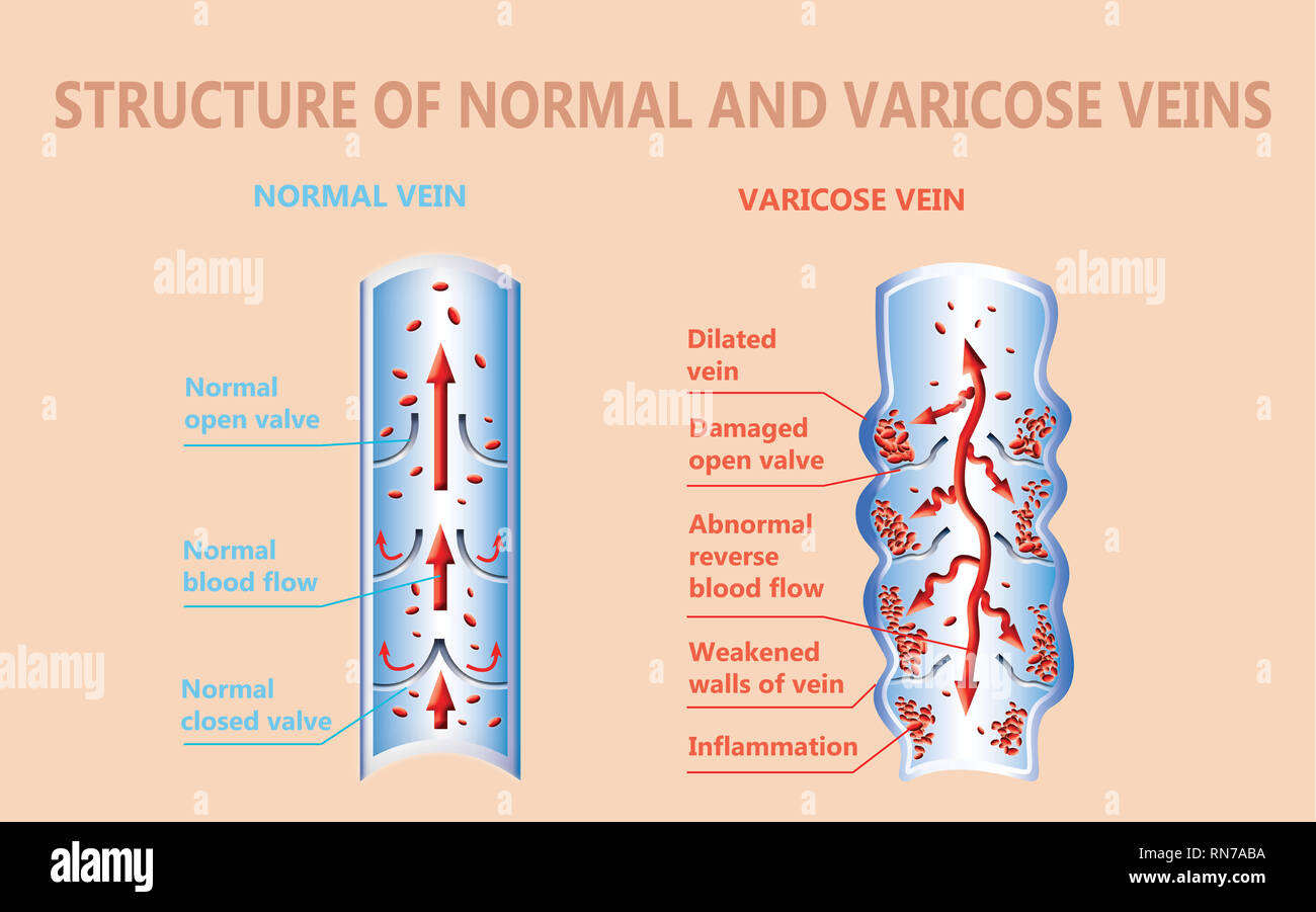 Varicose veins on a female senior legs. The structure of normal and ...