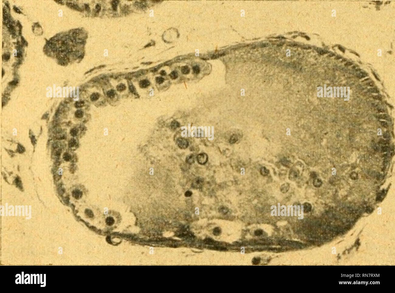 Nekrose hi-res stock photography and images - Alamy