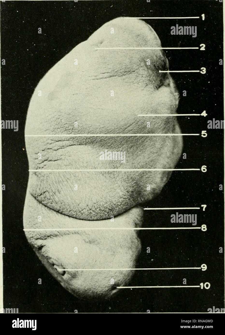 Abnormal fetus hi-res stock photography and images - Alamy