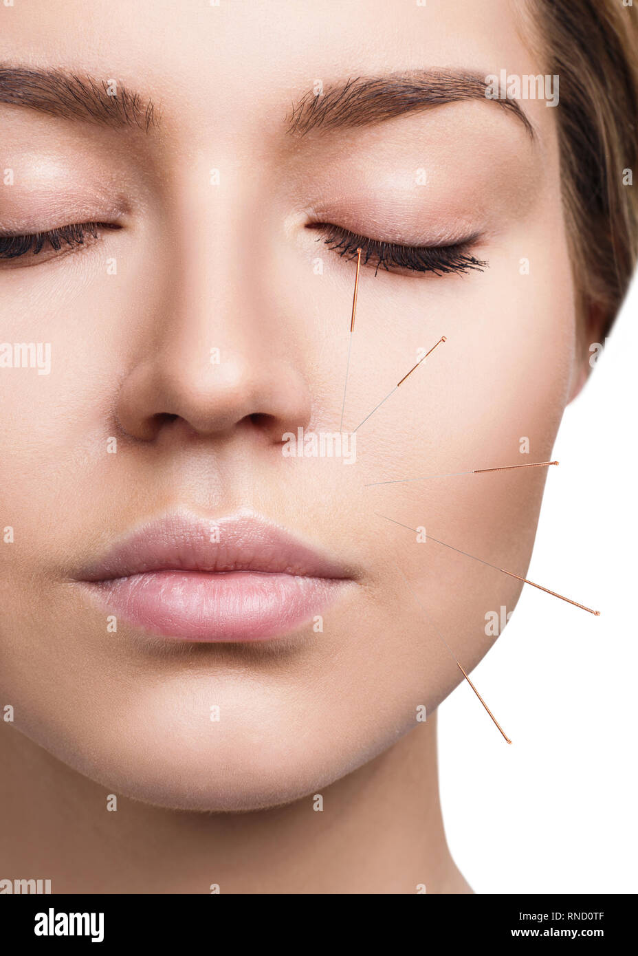 Acupuncture procedure hi-res stock photography and images - Alamy