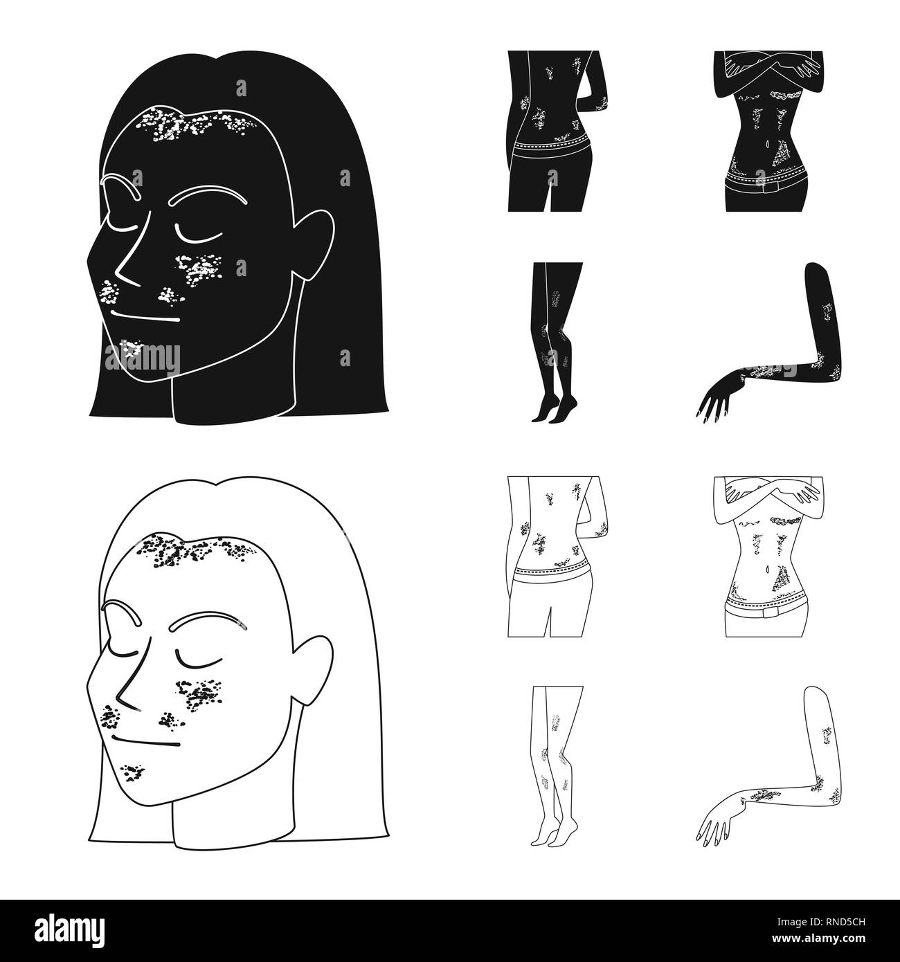 psoriasis,skin,body,dermatitis,chronic,allergy,eczema,itch,rash,stress ...