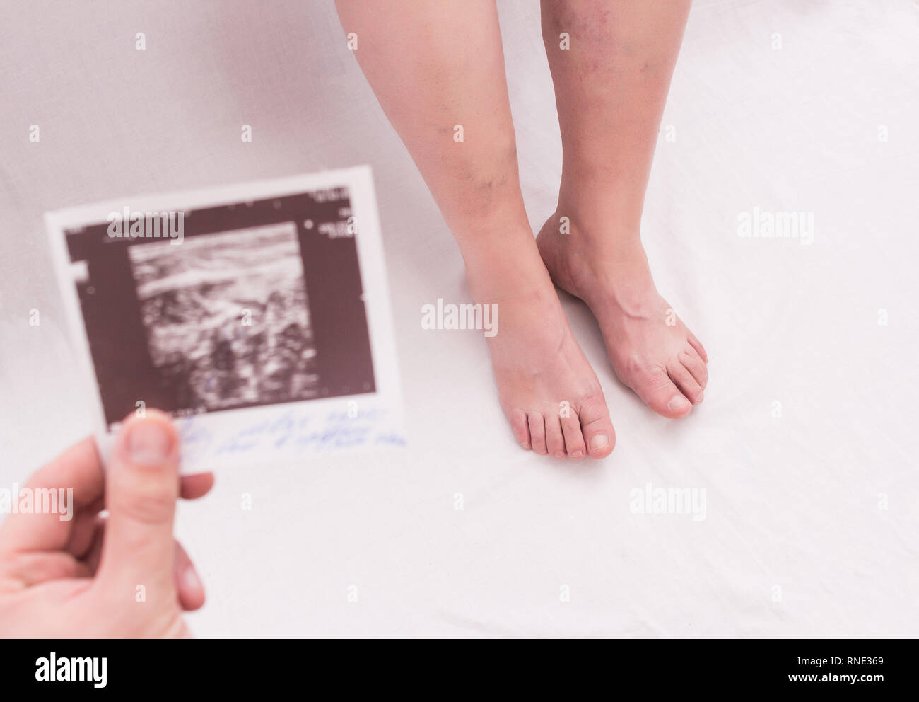 Vein thrombosis hand hi-res stock photography and images - Alamy