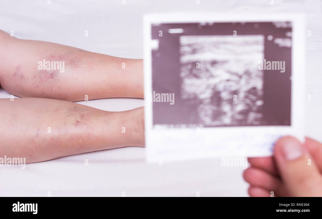 Thrombophlebitis In Fingers