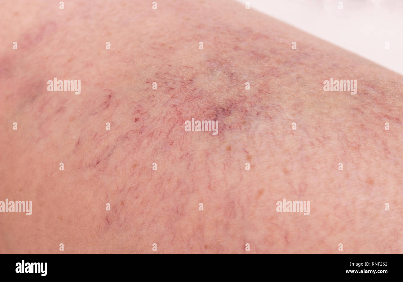 Footprint on the skin from vascular dilatation of veins, vascular ...