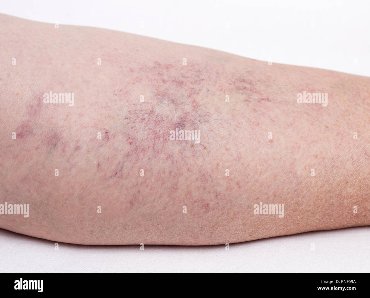 Vascular marks on the skin from varicose veins, vascular pattern on the ...