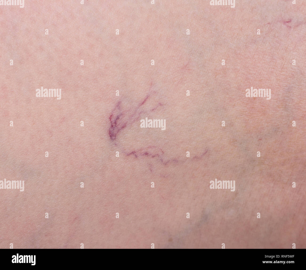 Footprint on the skin from vascular dilatation of veins, vascular ...