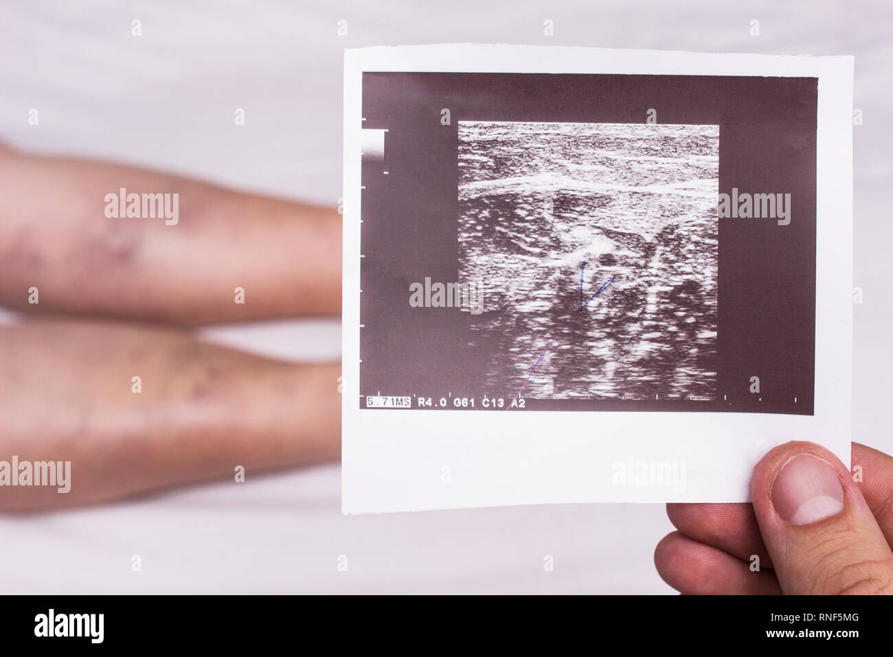 Vein thrombosis hand hi-res stock photography and images - Alamy