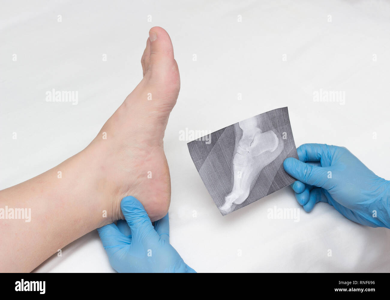 Osteophytes hi-res stock photography and images - Alamy