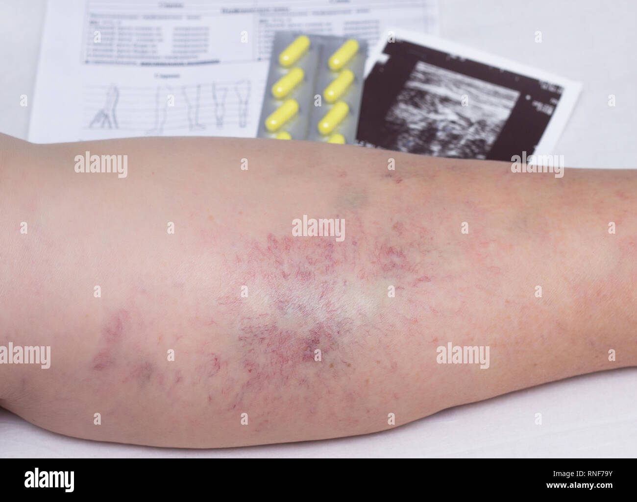 Female elderly leg with varicose veins, next to it is an examination ...