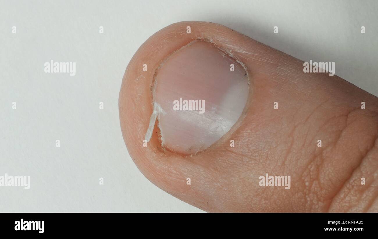 Broken toenail man hi-res stock photography and images - Alamy
