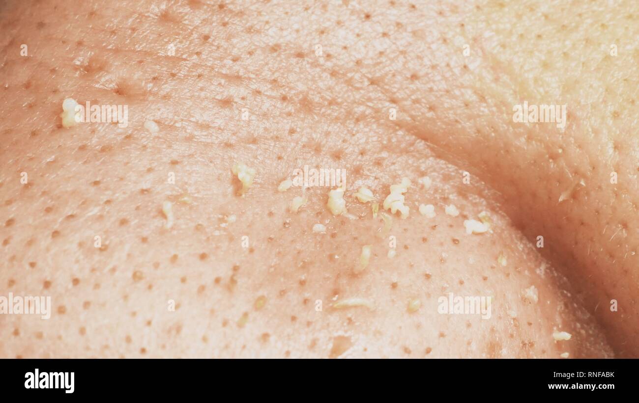 skin dermatology, man's face with pimples Stock Photo - Alamy
