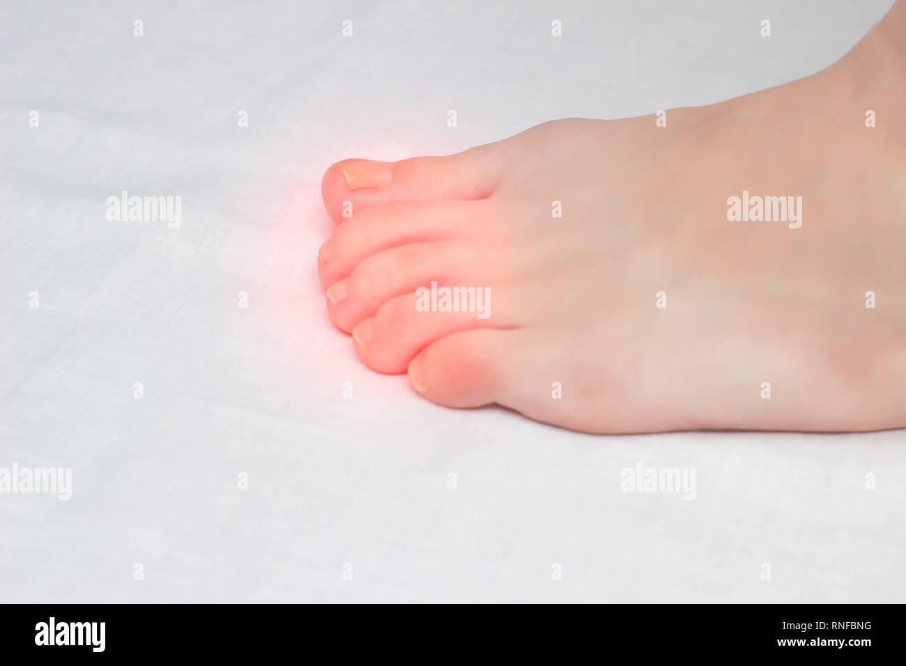 female foot with fungal infection on toes, close-up, white background ...