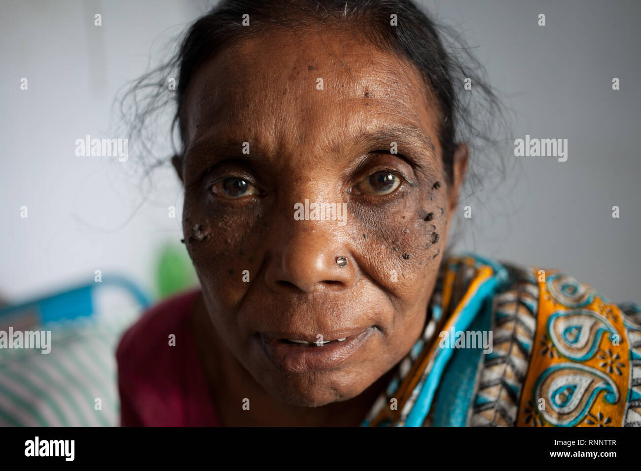 Eldry people who effected by leprosy living togather in a old care ...