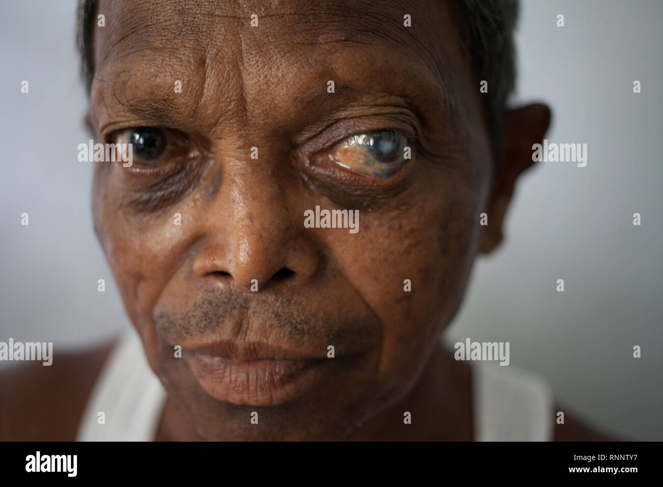 Eldry people who effected by leprosy living togather in a old care ...